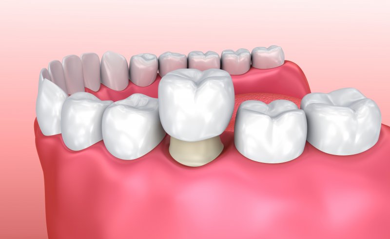 Cracked Dental Crown | Crown Breaks | Glisten Dental